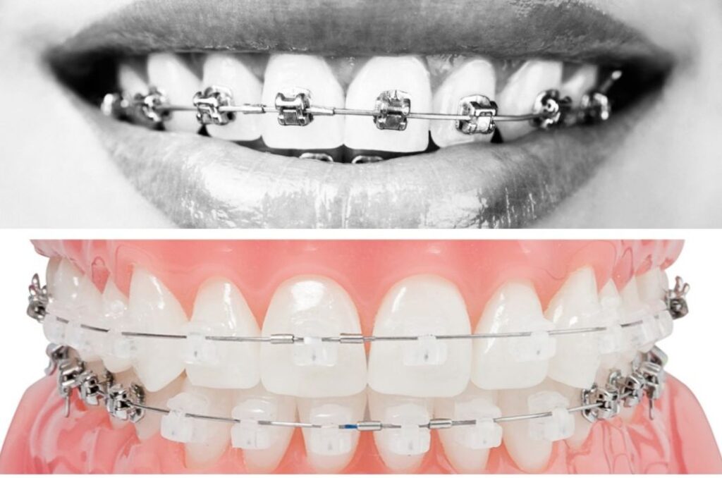 Disjunctor dentar sau maxilar: rol si pret | Dental Premier