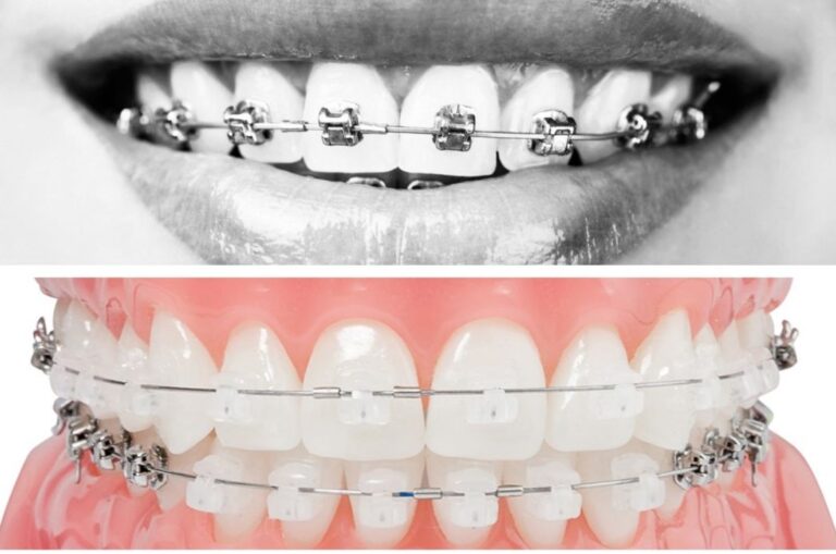 Disjunctor dentar sau maxilar: rol si pret | Dental Premier