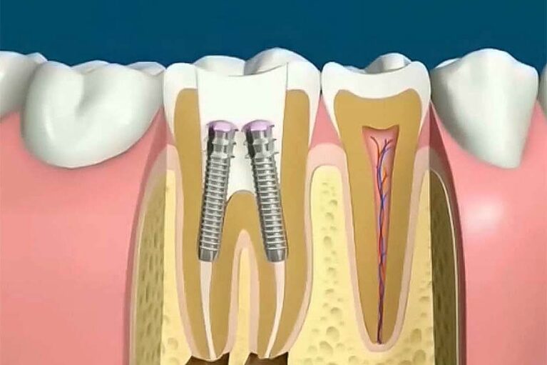 Disjunctor dentar sau maxilar: rol si pret | Dental Premier