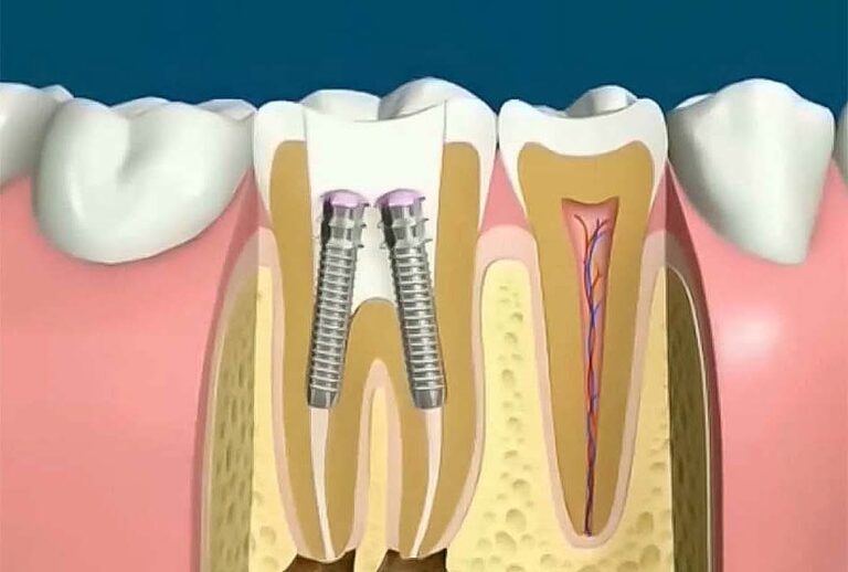 Disjunctor dentar sau maxilar: rol si pret | Dental Premier