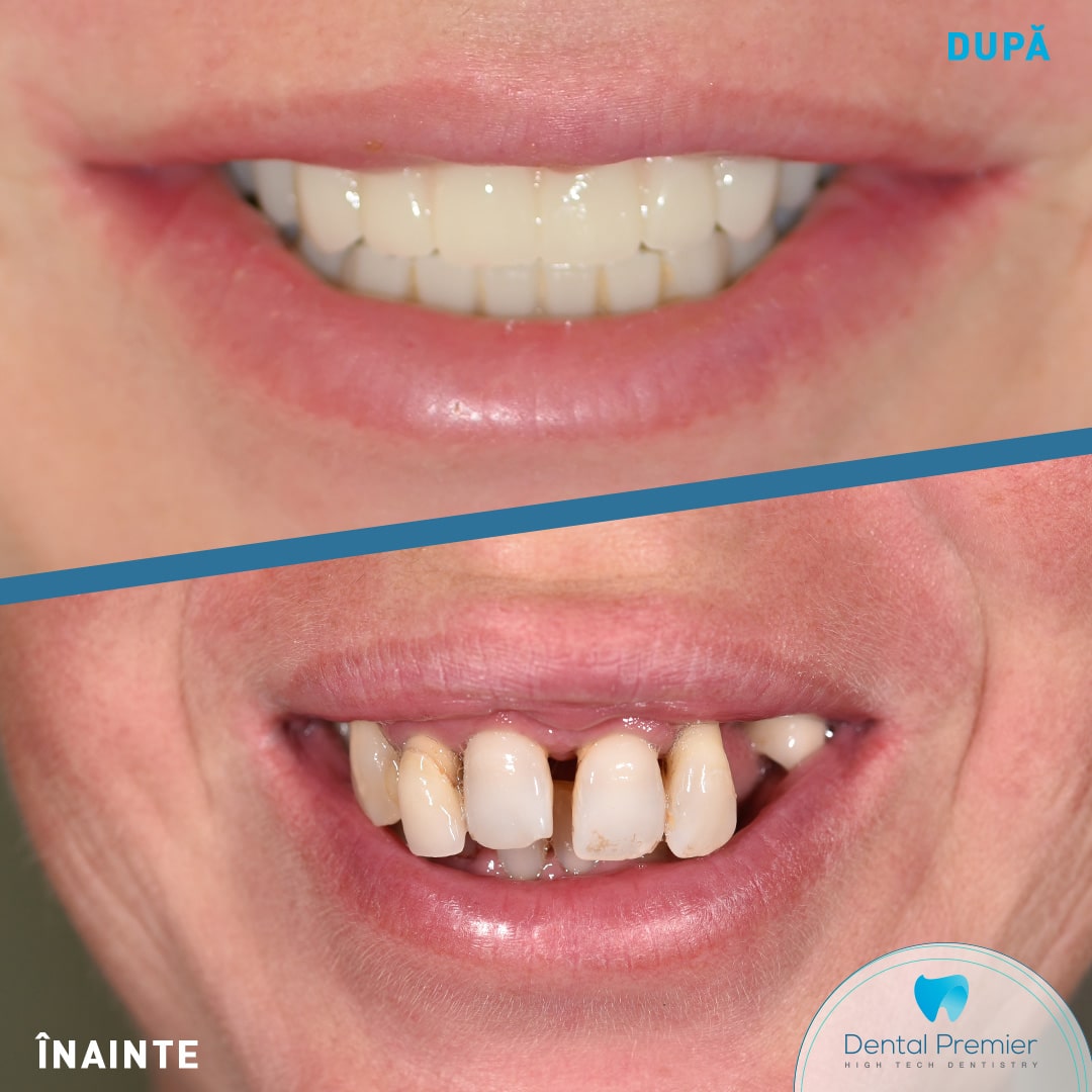 Implant Dentar Ultima Tehnologie | Implanturi Dentare in 24 ore