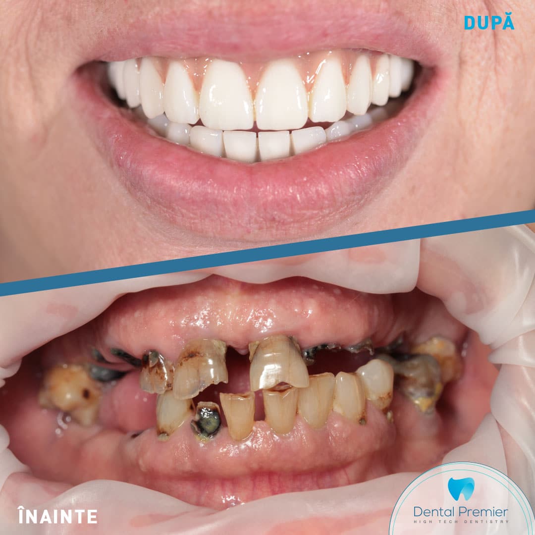 Proteze dentare totale fixe cu 6 si 4 implanturi dentare | Pacienta 67 ani